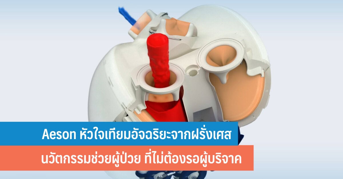Aeson หัวใจเทียมอัจฉริยะจากฝรั่งเศส นวัตกรรมช่วยผู้ป่วยที่ไม่ต้องรอผู้ ...